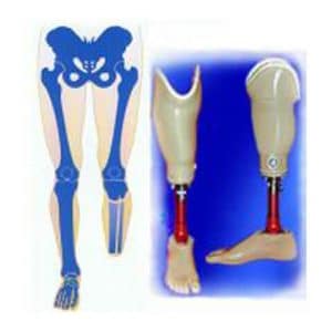 Benprotese | Nye kunstige benproteser til en skarp pris